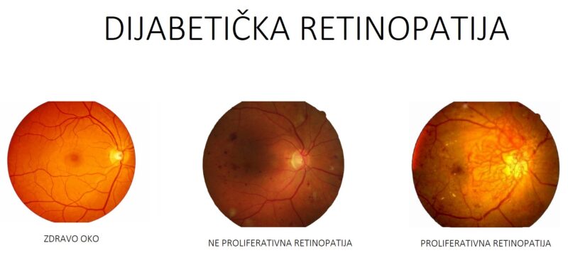 Oftalmološka poliklinika Dr. Balog - Dijabetička retinopatija
